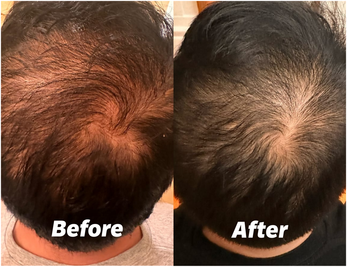 BLMO-Alopecia treatment products, Hair loss solution.